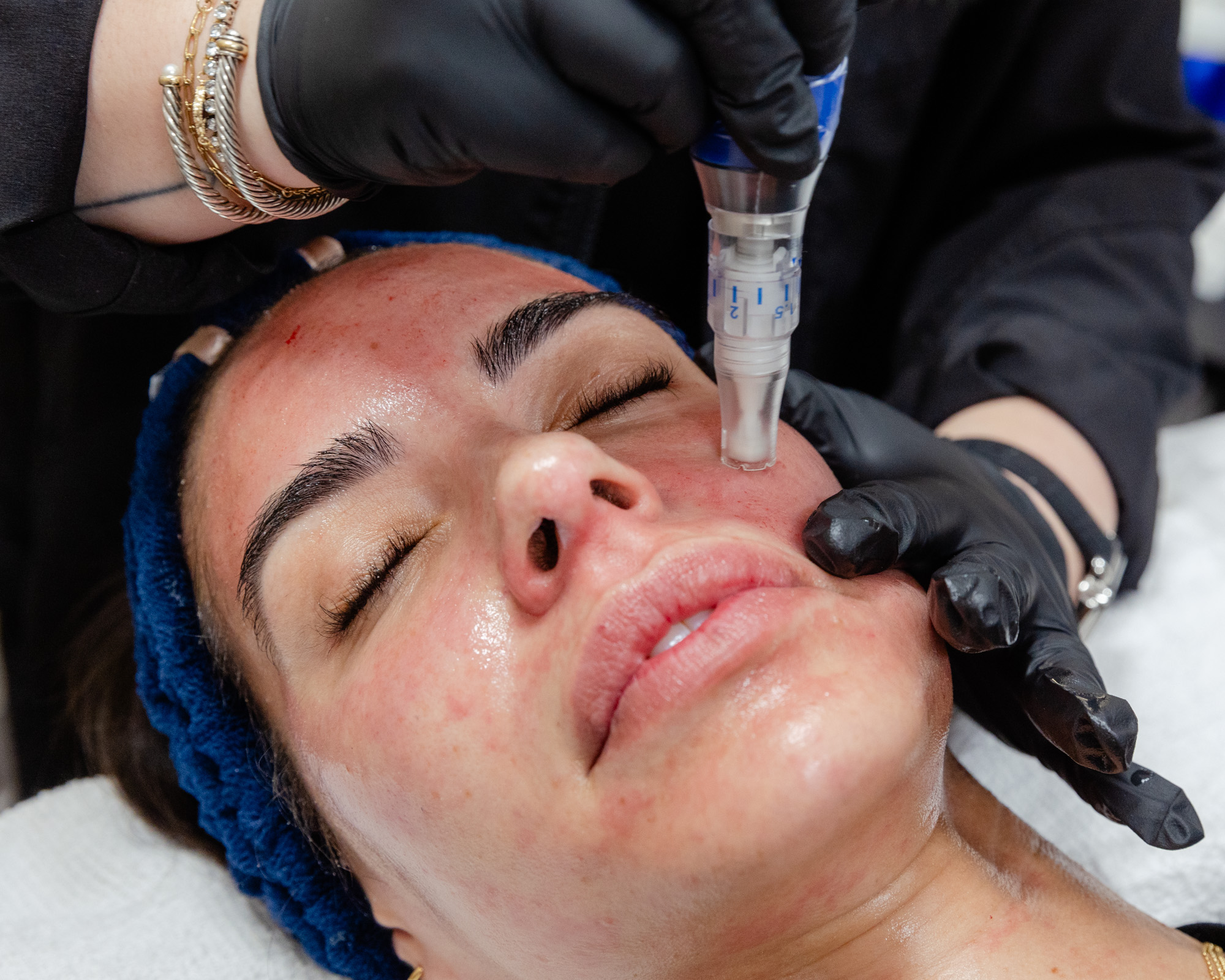 Microneedling Treatment in Denville NJ | Collagen Production
